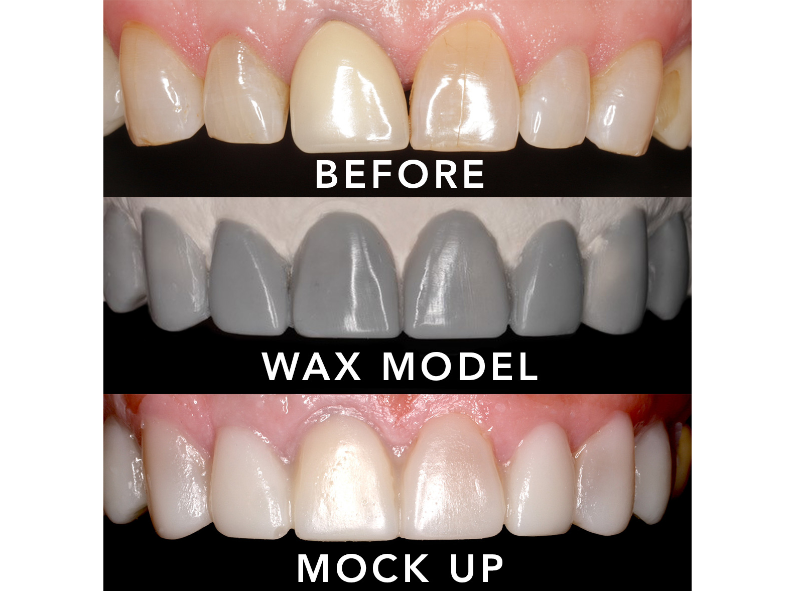 Visualize Your Smile Diagnostic Wax up News Spaulding Dental Co Visualize Your Smile Diagnostic Wax up News Spaulding Dental Co
